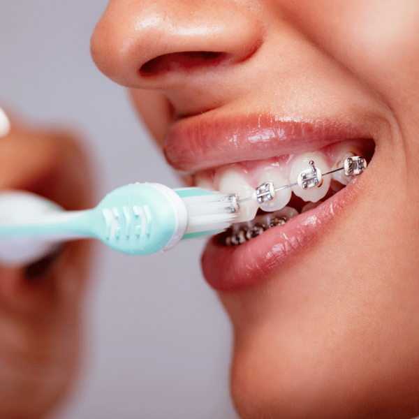 Retainers vs. Permanent Retainers: What's Best After Braces? - Villa ...