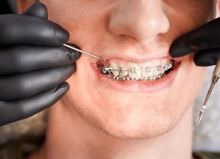 Braces Before and After Jaw Surgery - Villa Orthodontics